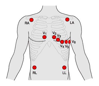 Ecg Placement Leads Diagram