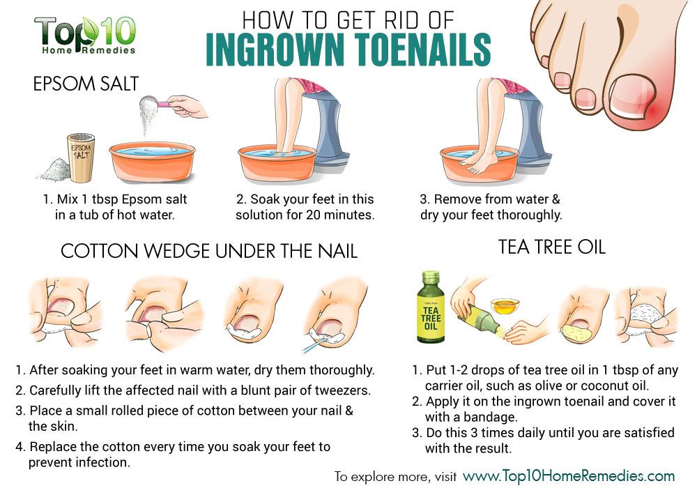 Ingrown Toenail Diagram
