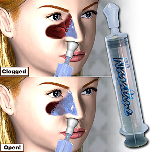 Flow Of Neti Pot Diagram Pot Neti Safe