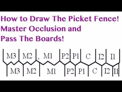 Picket Fence Diagram For Occlusion